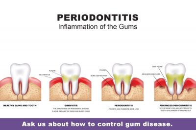 Periodontal Treatment: Deep Cleaning, Scaling and Root Planing ...